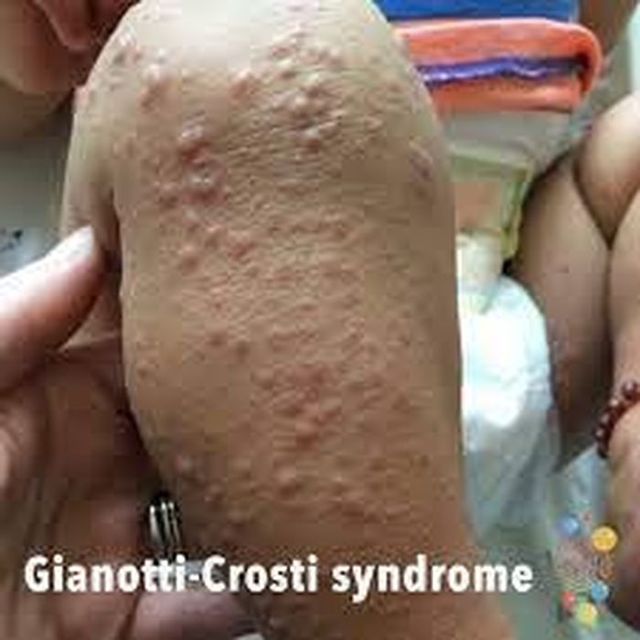 Tìm hiểu về hội chứng phát ban Gianotti-Crosti hiếm gặp ở trẻ nhỏ - Báo ...