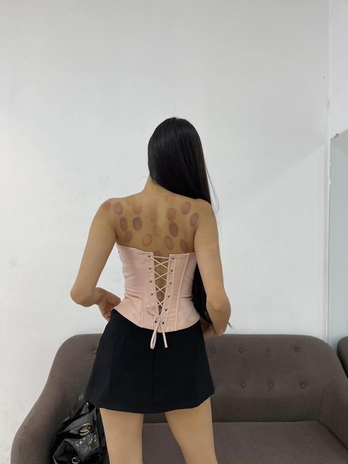 Hoàng Thùy lộ rõ sức khỏe đáng lo, lưng chẳng chịt vết bầm đỏ - Tạp chí ...